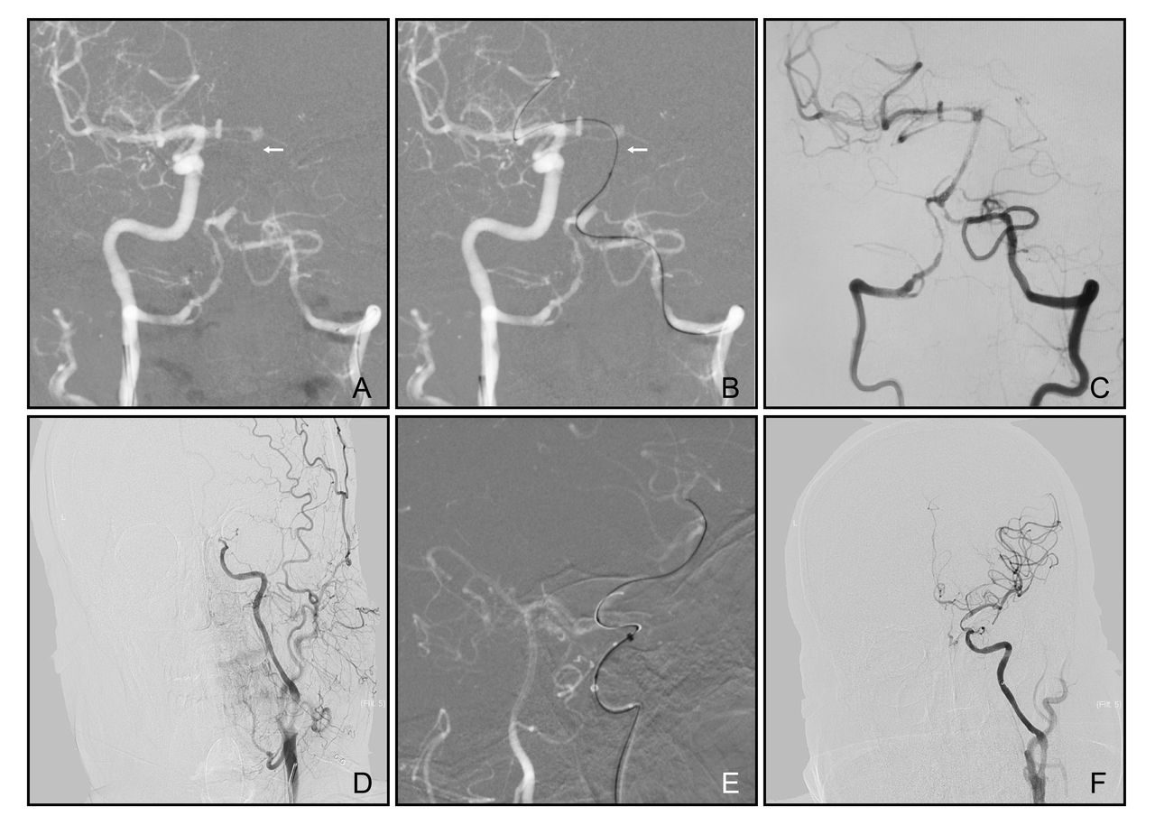 Dual-roadmap guidance for endovascular recanalization of medically ...