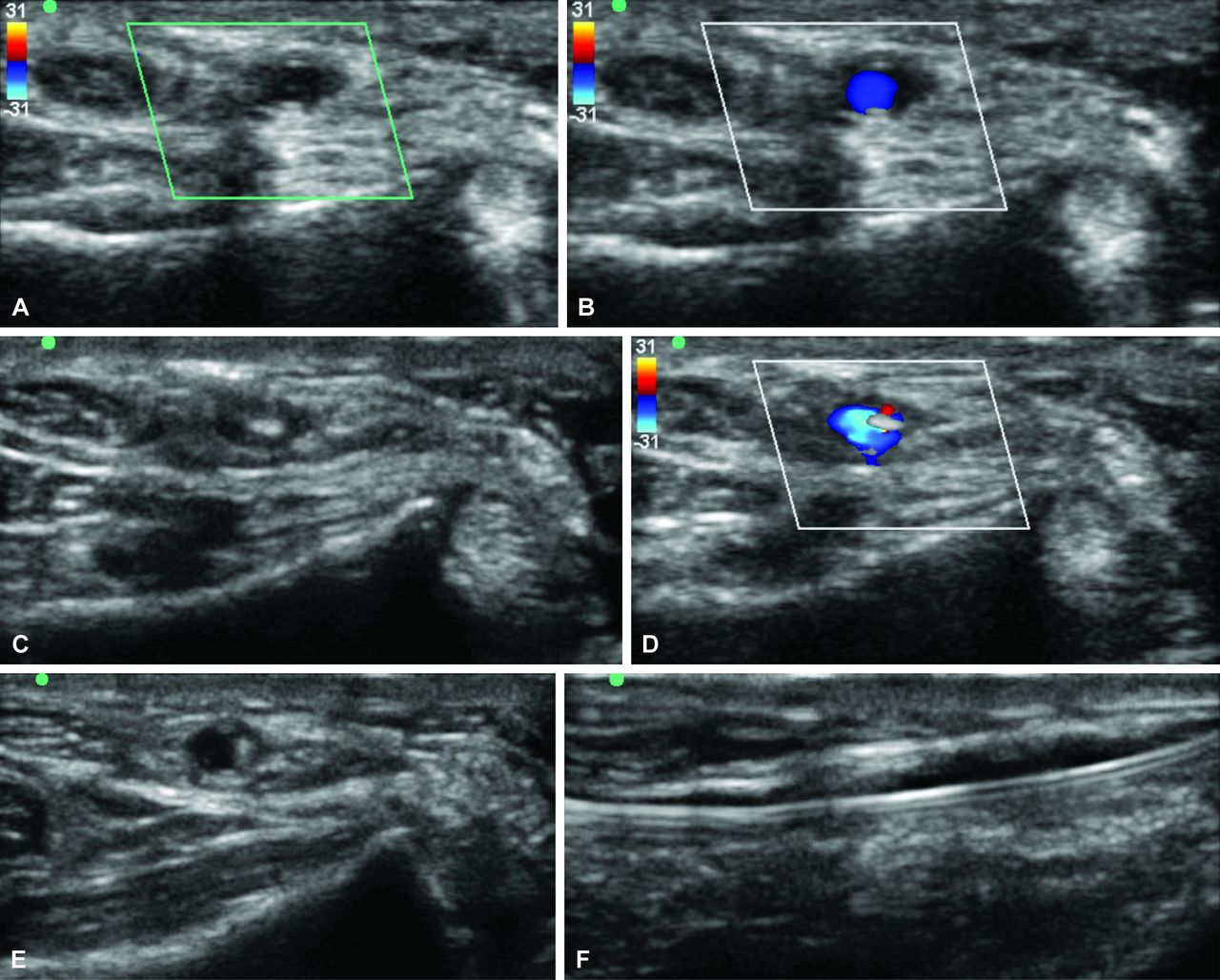 Reaccessing an occluded radial artery for neuroendovascular procedures ...
