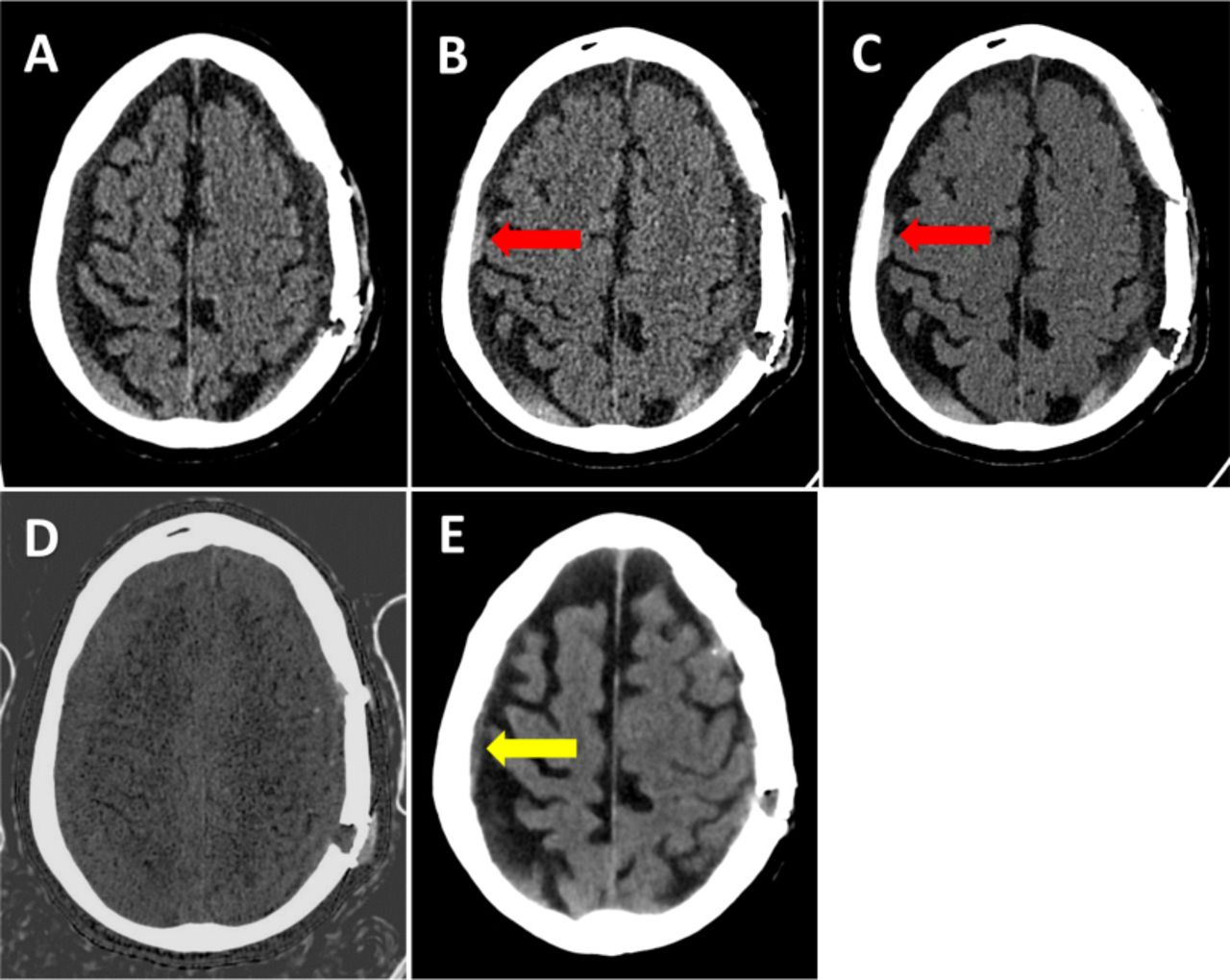 Utilizing dual energy CT to distinguish blood from contrast leakage ...