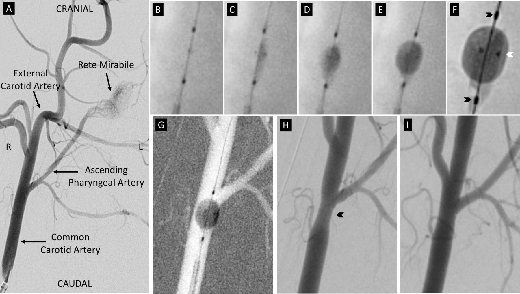 Endovascular transmural access to carotid artery perivascular tissues ...