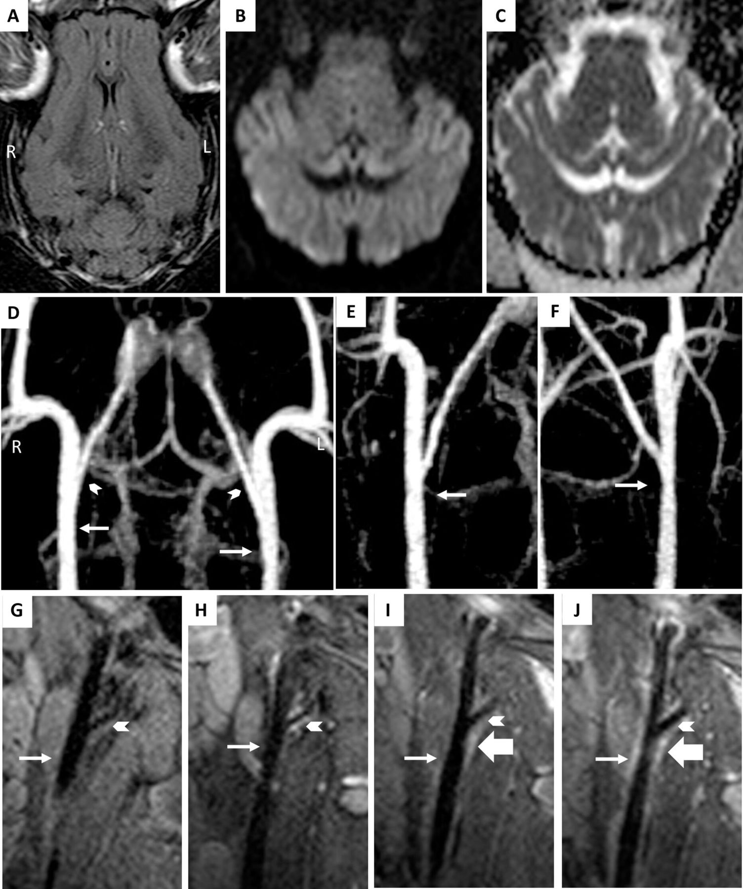 Endovascular transmural access to carotid artery perivascular tissues ...