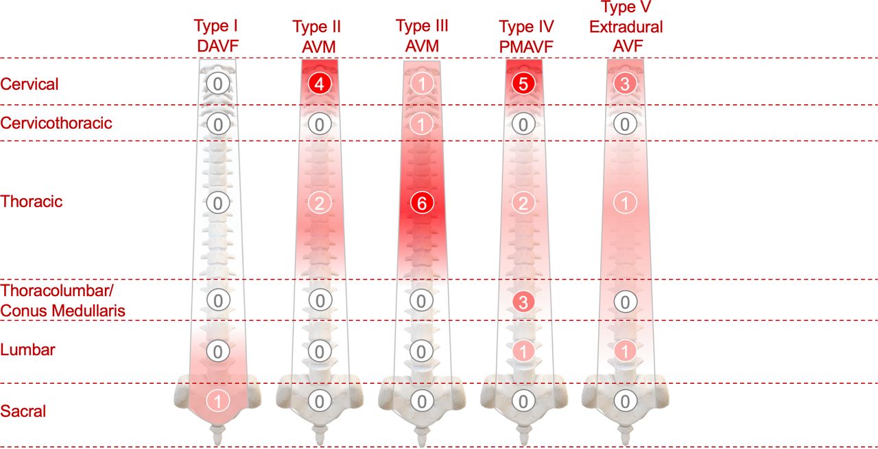 Clarifying the clinical landscape of pediatric spinal arteriovenous ...