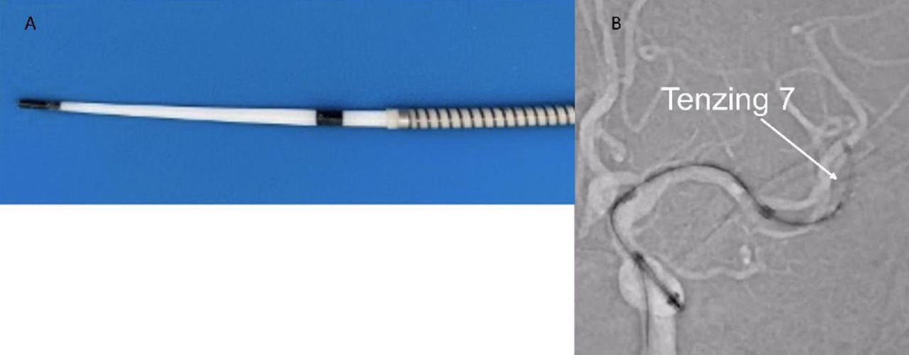 O-064 Intracranial dotter angioplasty using tenzing 7 for symptomatic ...