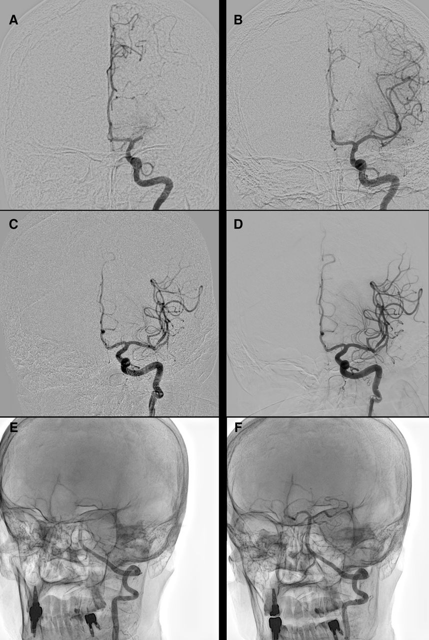 Cineangiography versus standard digital subtraction angiography in ...