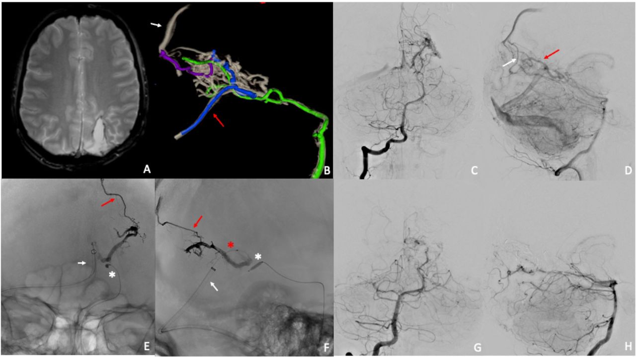 Transvenous embolization of brain arteriovenous malformations featuring ...