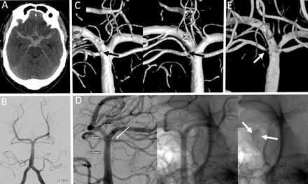 Neuroanatomy of the vertebrobasilar perforators: implications for ...