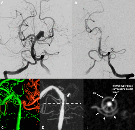 Neuroanatomy of the vertebrobasilar perforators: implications for ...
