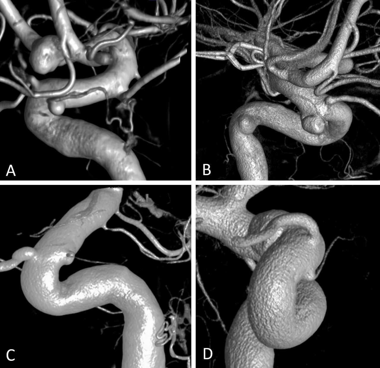 Superior Hypophyseal Arteries Angiographic Re Discovery Comprehensive