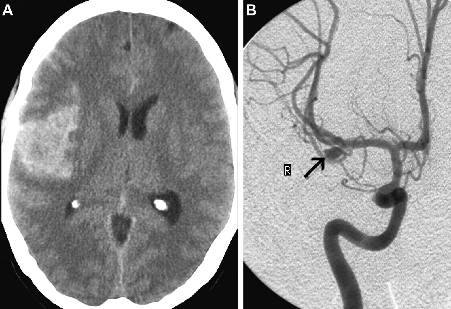 Bilateral mirror posterior inferior cerebellar artery aneurysms ...