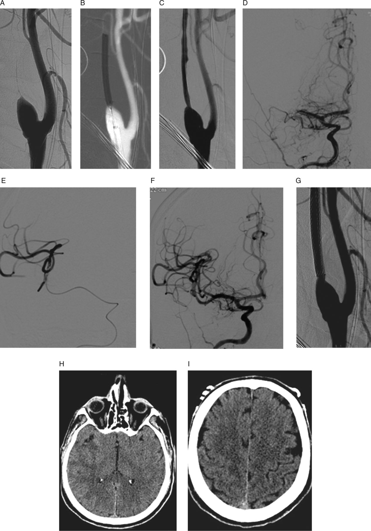 Emergent stent-assisted angioplasty of extracranial internal carotid ...