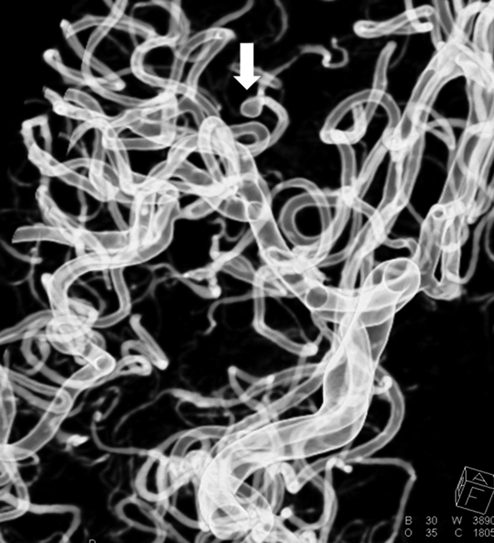 Mycotic aneurysm detection rates with cerebral angiography in patients ...