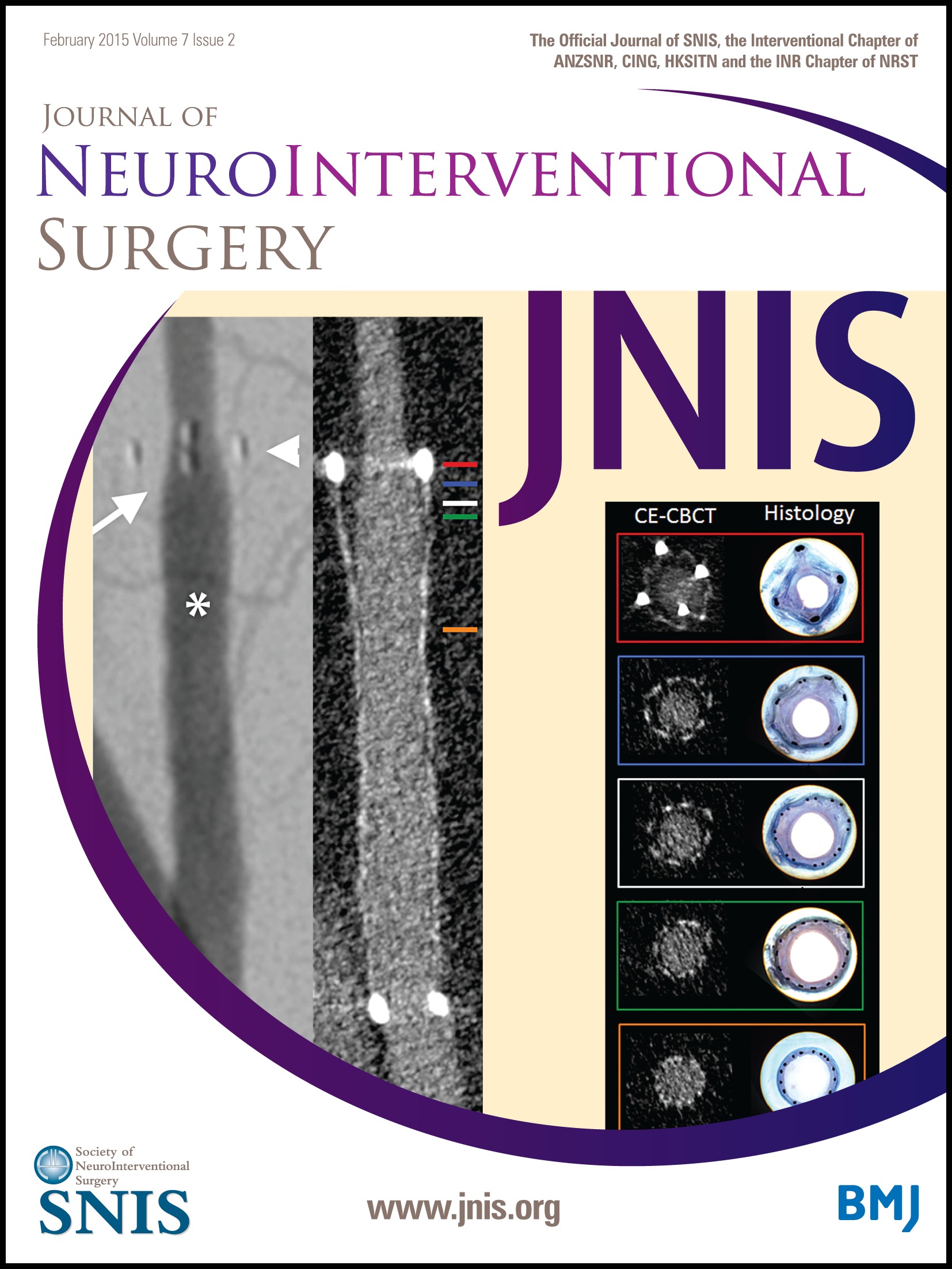 Table of contents | Journal of NeuroInterventional Surgery